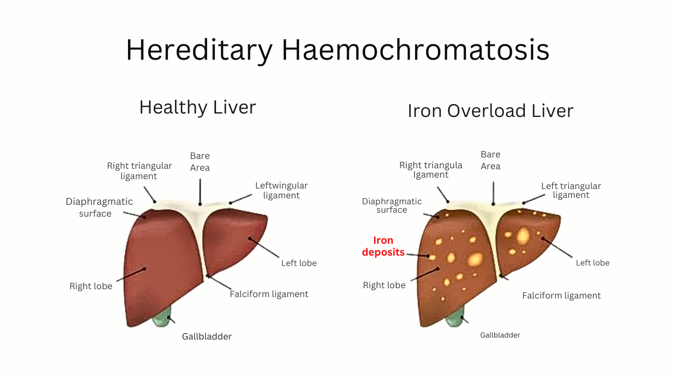 Evverything about Hemochromatosis: Iron Overload Disease
